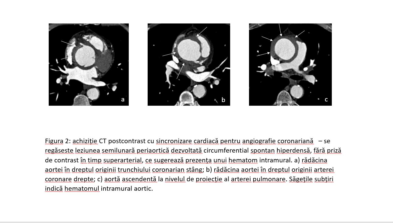 Caz 1: hematom intramural aorta ascendenta - Ghid radiologie