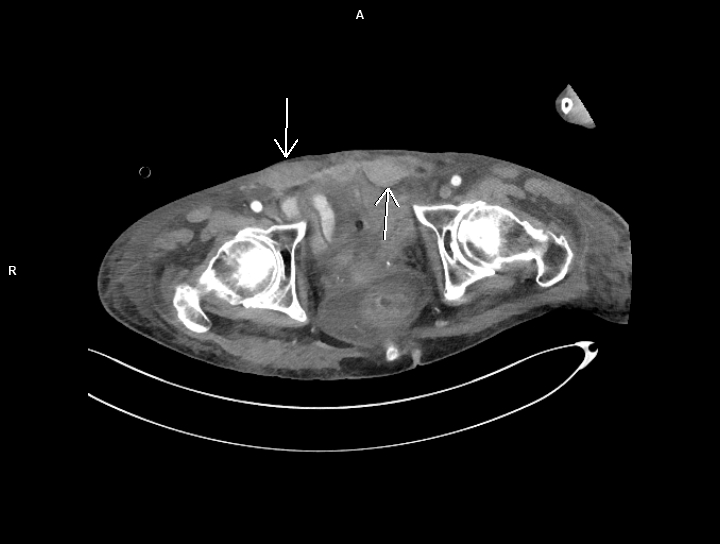 CAZ nr 37 Apoplexie esofagiană - Ghid radiologie